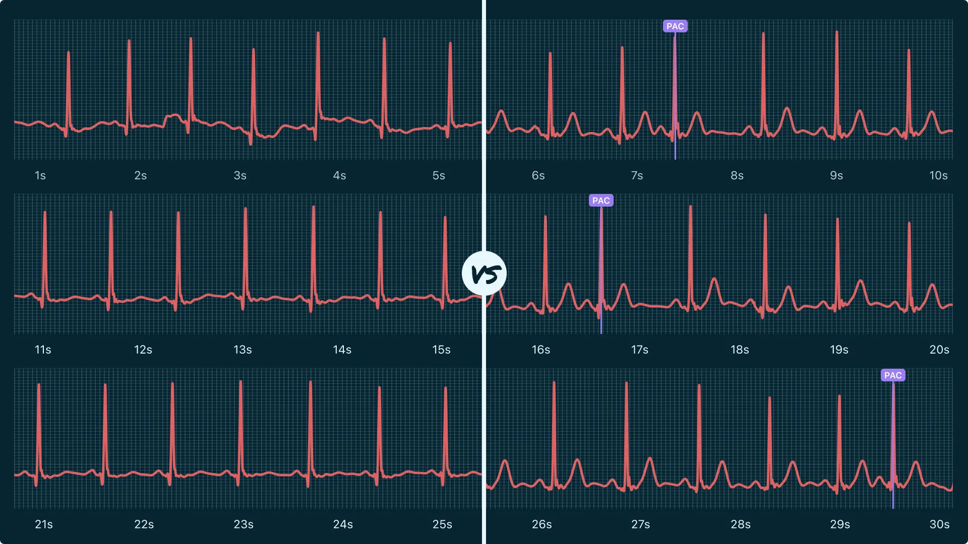 Qaly | How To Read Your ECG